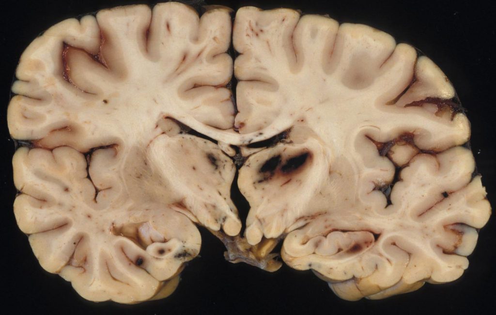 BRAIN UK Ref: 12/008 – Protein conformation changes in chronic traumatic encephalopathy and ...